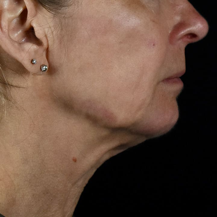 Jaw & Chin Contouring | McKeown Medical