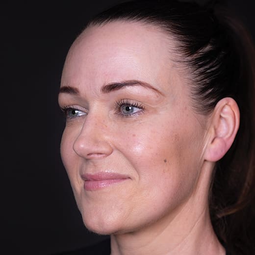 Heavy Upper Eyelids | Dr Darren McKeown