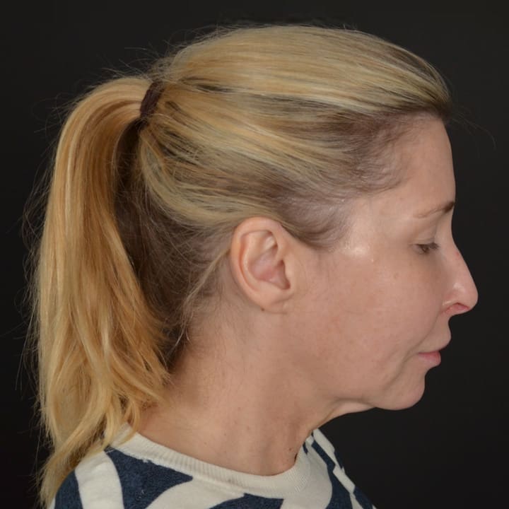 Deep Plane Face & Neck Lift | Dr Darren McKeown