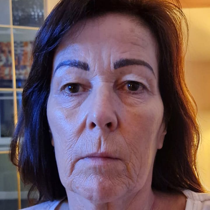 Full Facelift | Procedure & Options | McKeown Medical