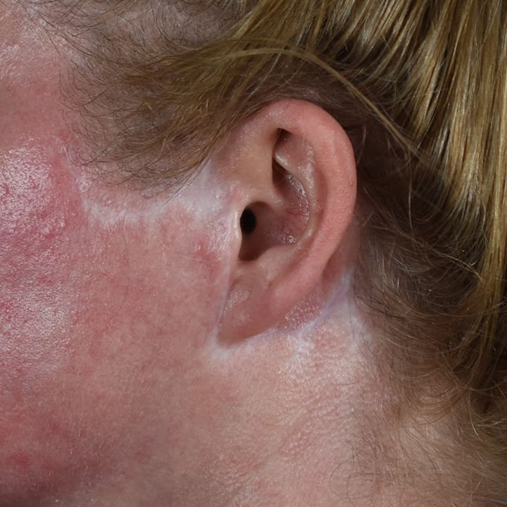 Scar Treatments | McKeown Medical
