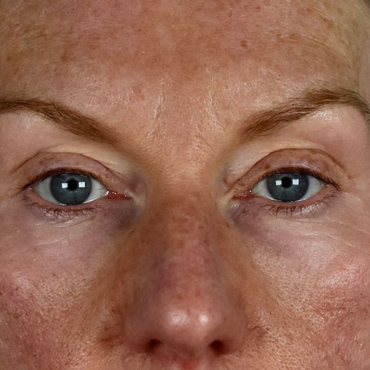 Laser eye lift store
