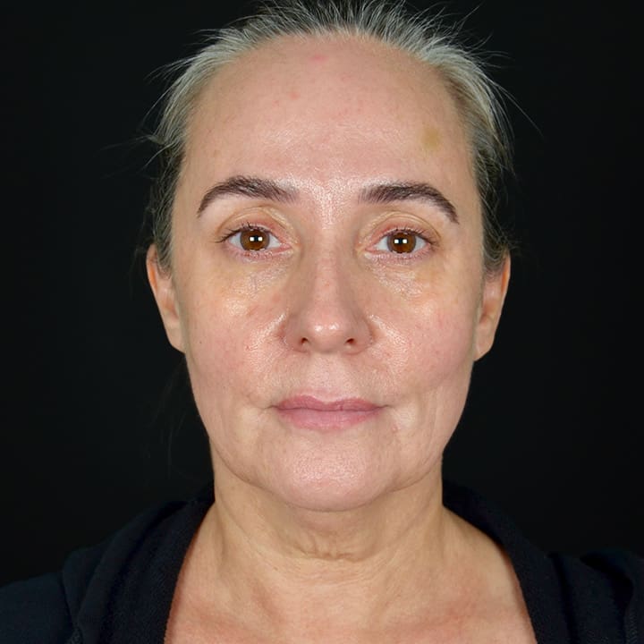 Full Facelift | Procedure & Options | McKeown Medical