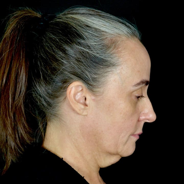 Jowl Lift Treatment: Surgical & Non-Surgical Options | McKeown Medical