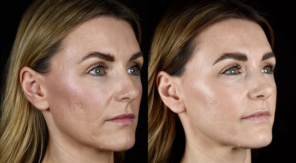 Can You Get Rid of Acne Scars? | McKeown Medical