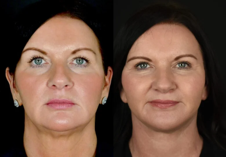 Mini vs Deep Plane Facelift | McKeown Medical